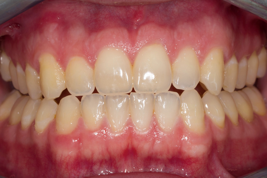 What Dentists Need to Know About Wedding Teeth Whitening - Optident