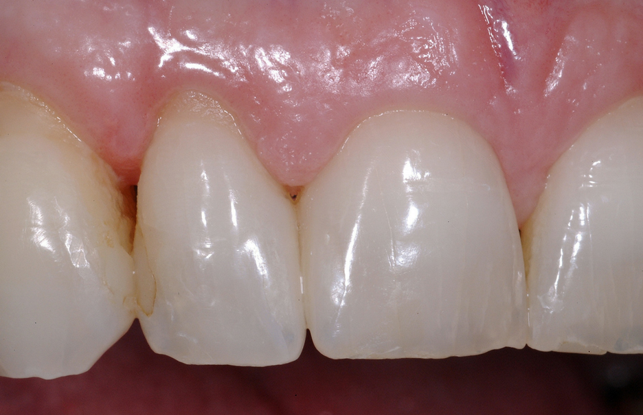 A Modern Day And Predictable Approach To Gingival Embrasures - Optident