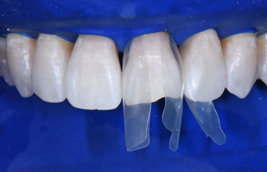 How Bioclear Empowers Dentists To Treat Black Triangles - Optident