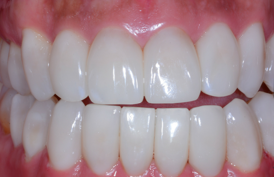 How Bioclear Empowers Dentists To Treat Black Triangles - Optident