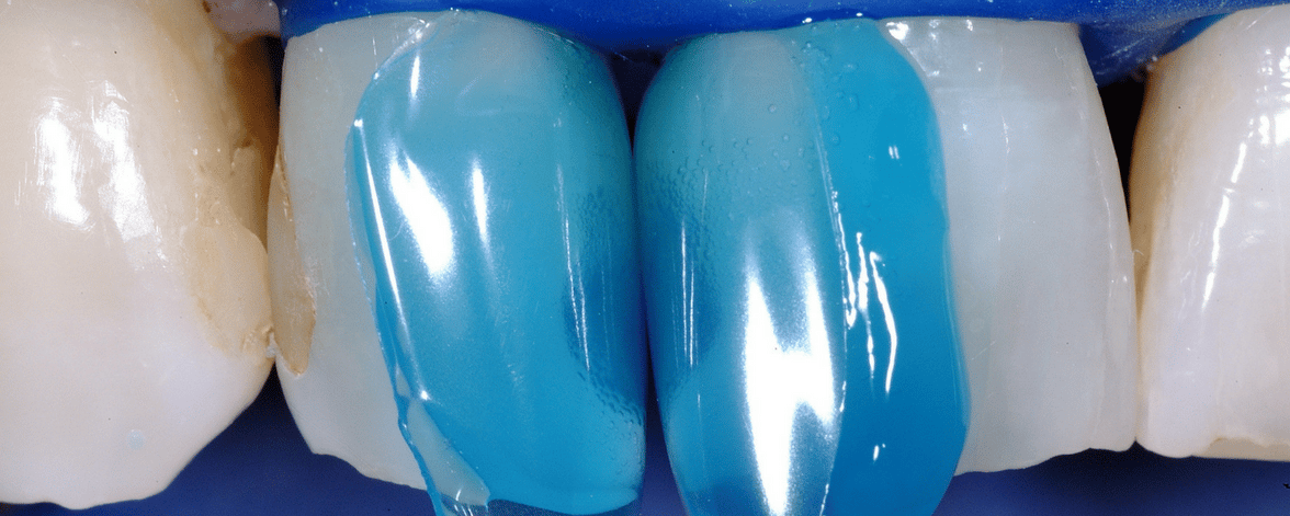 A Modern Day And Predictable Approach To Gingival Embrasures - Optident