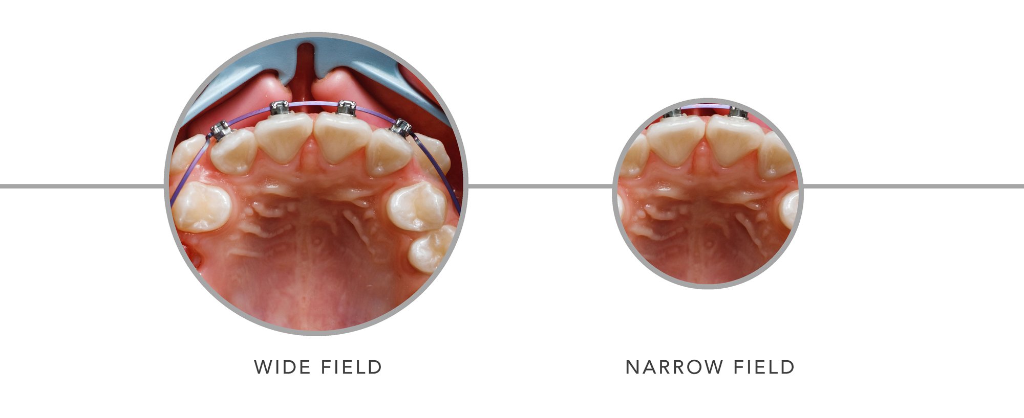 5 Things To Look For When Buying Dental Loupes - Optident