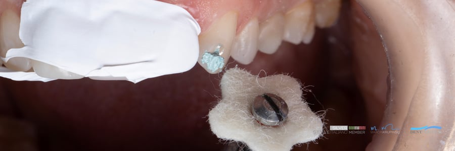 Why Everyone’s talking about Lucida - Optident