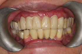 Ribbond: A Fantastic Treatment Modality To Introduce To Your Practice ...