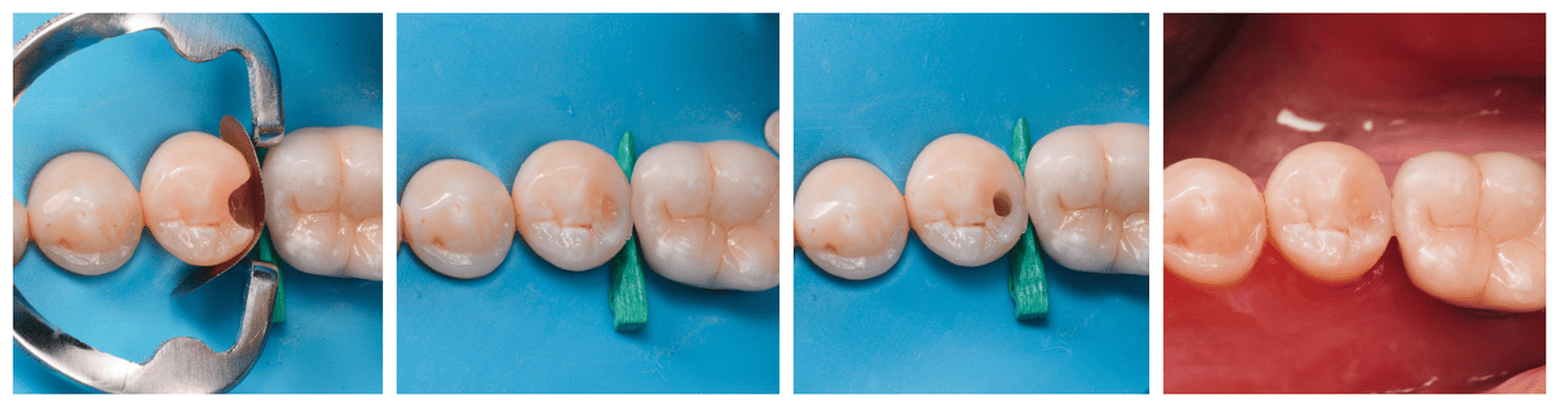 The Usual Suspects: Five Causes Of Post-op Sensitivity - Optident