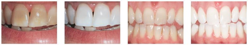 Go For Gold With Opalescence - Optident
