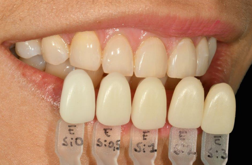 Optident Launches White Dental Beauty CompoSite! - Optident
