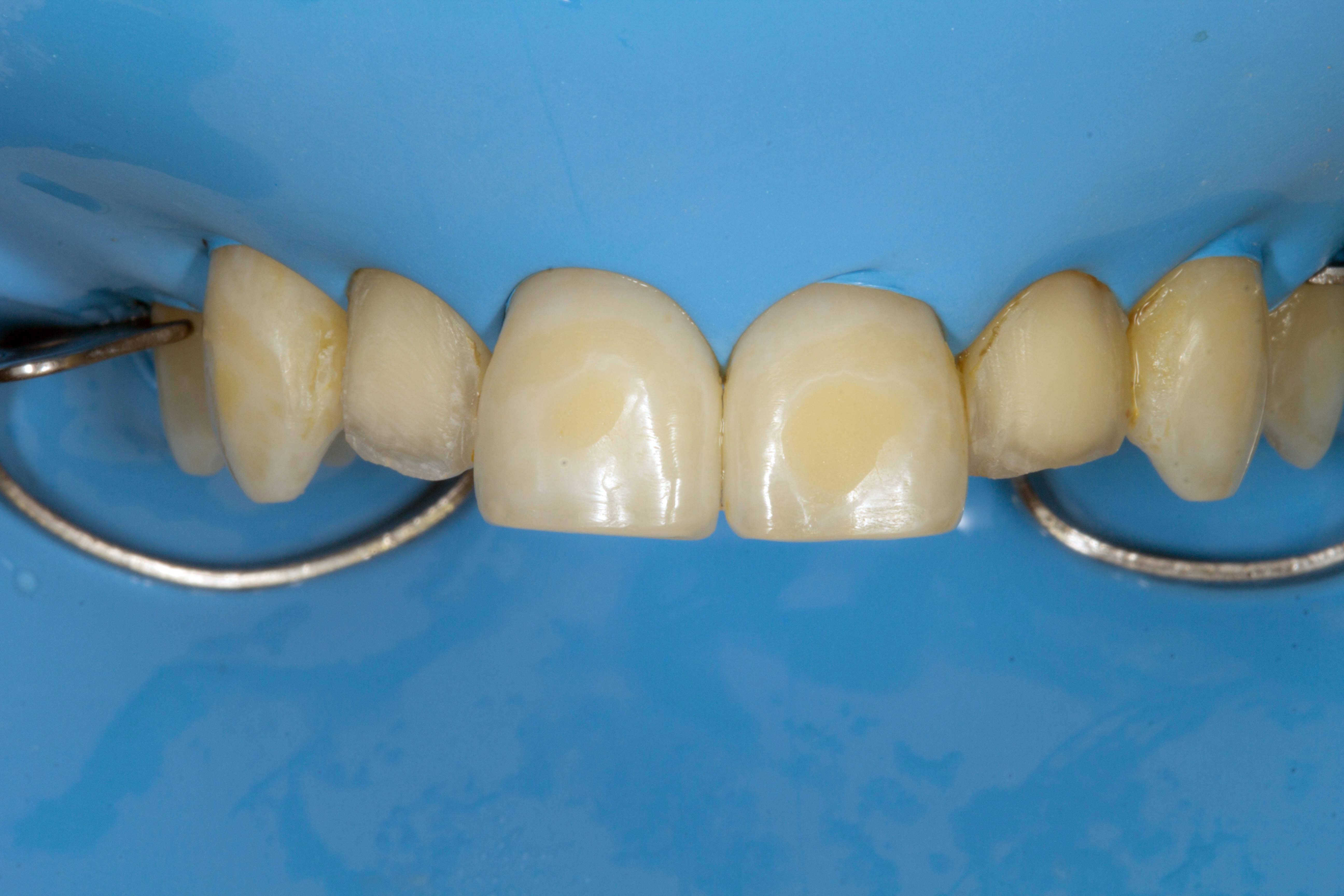 The Many Uses Of Polydentia Unica Anterior - Optident