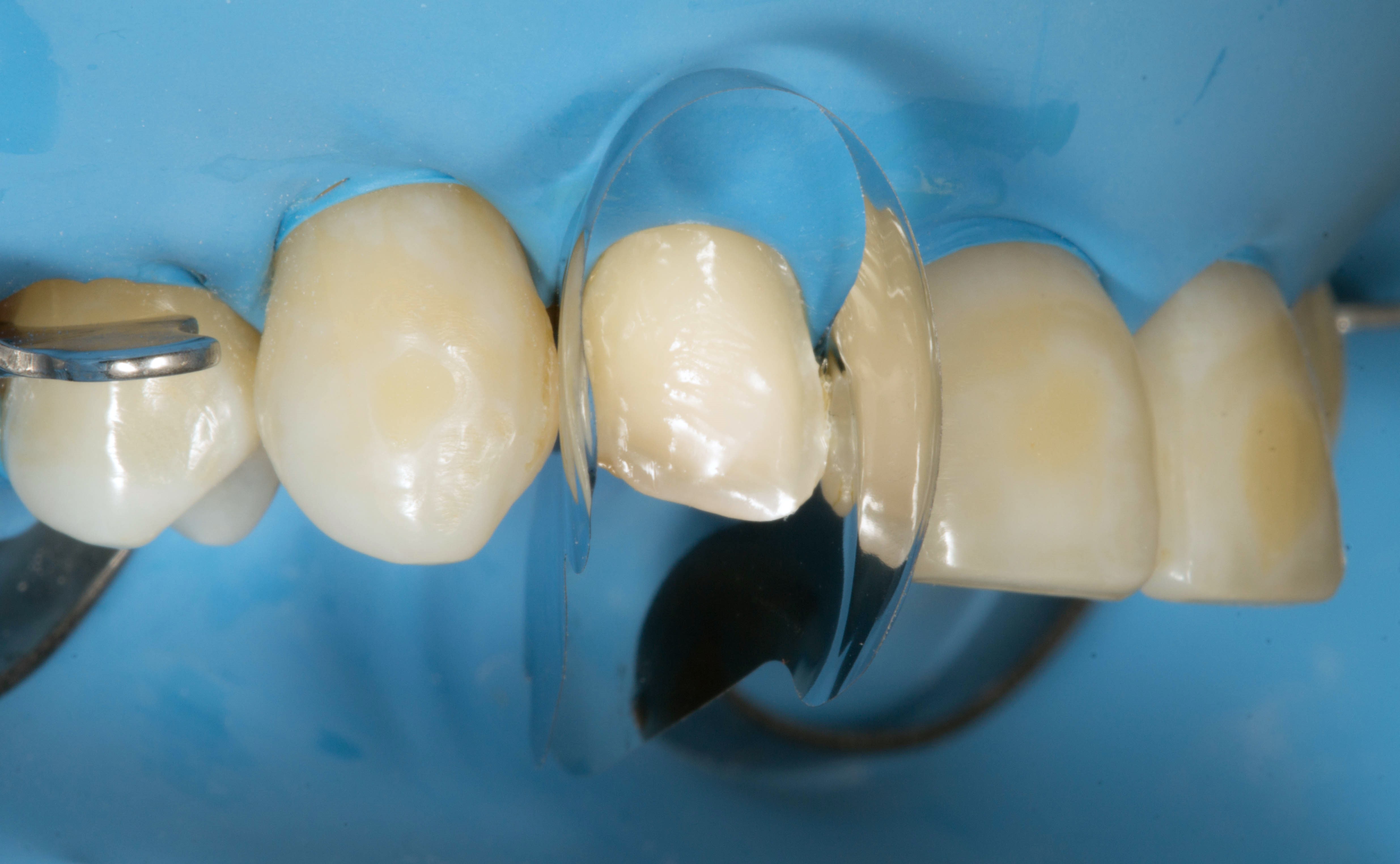 The Many Uses Of Polydentia Unica Anterior - Optident