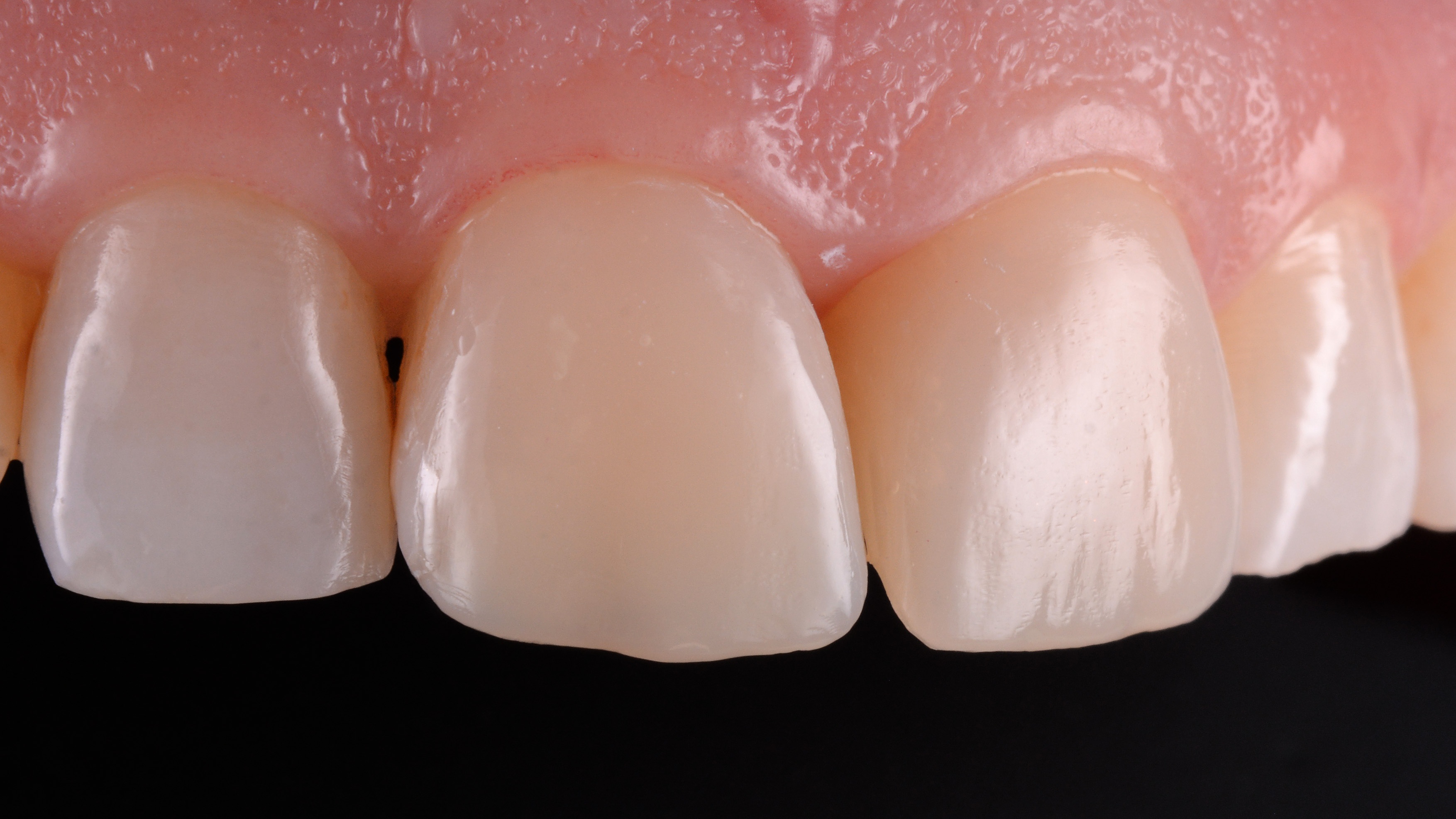 The Many Uses Of Polydentia Unica Anterior - Optident