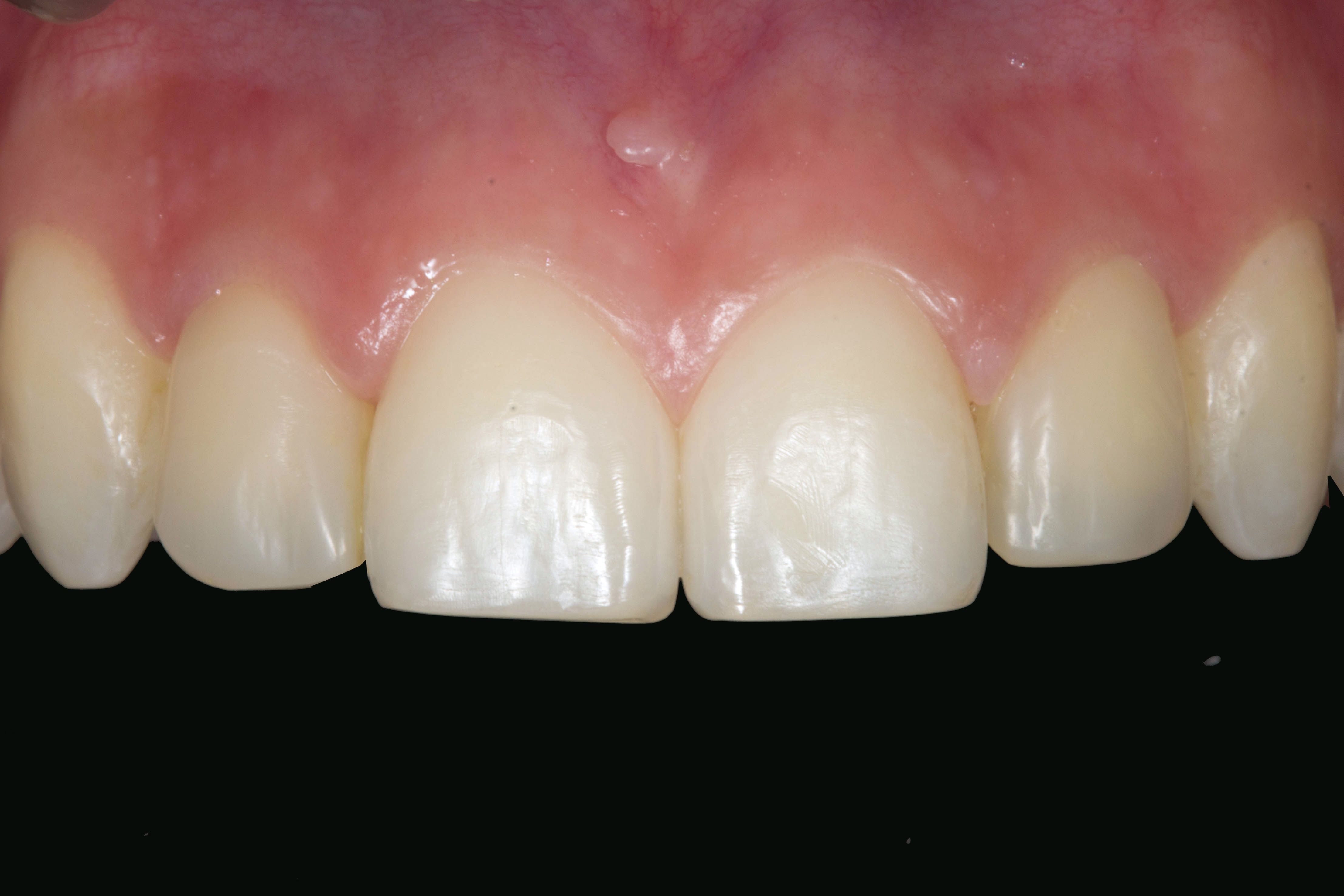 The Many Uses Of Polydentia Unica Anterior - Optident