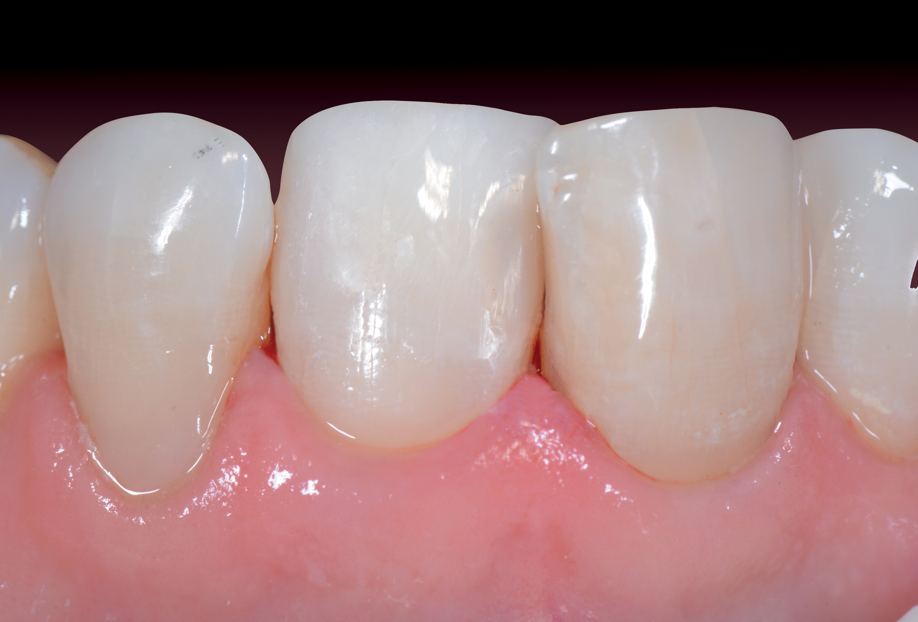 The Many Uses Of Polydentia Unica Anterior - Optident