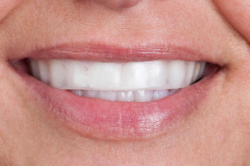 The Story of Opalescence Go! - Optident